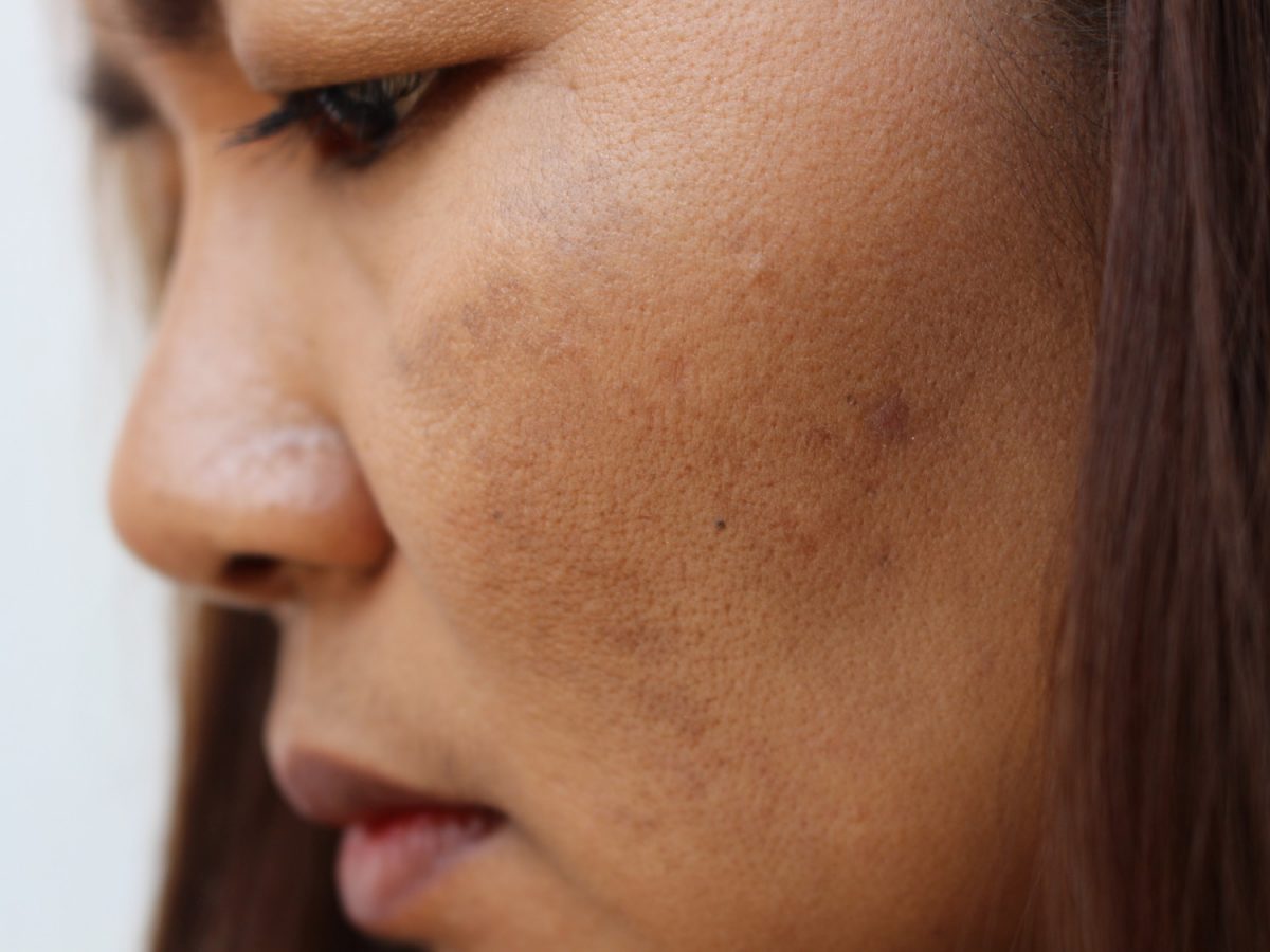 Hyperpigmentation - Causes & Treatment | Light Touch Clinic