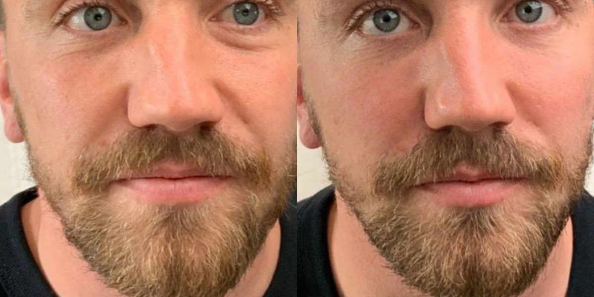 Dermal Fillers Before & After | Dermal Filler Treatment Results