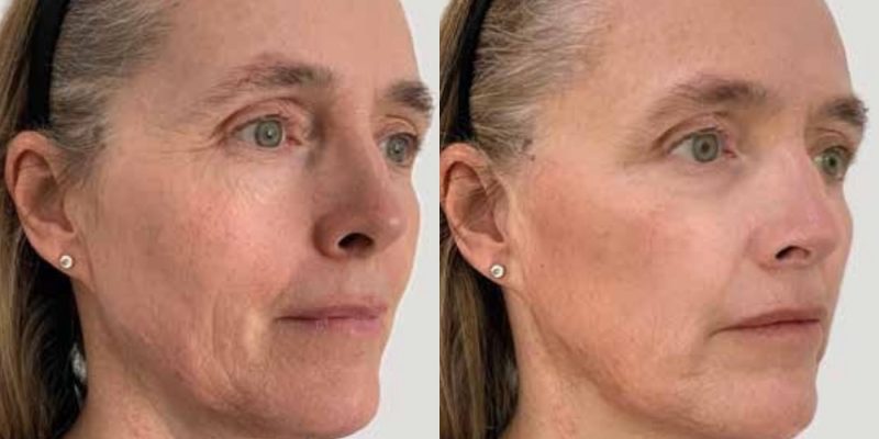 Profhilo Structura Before & After | Profhilo Structura Results