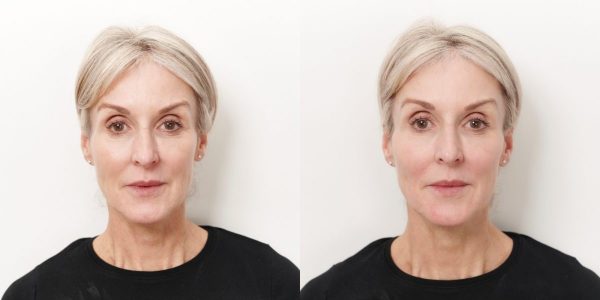 Cheek Fillers Before & After | Cheek Filler Treatment Results