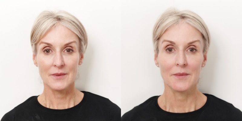 Cheek Fillers Before & After | Cheek Filler Treatment Results