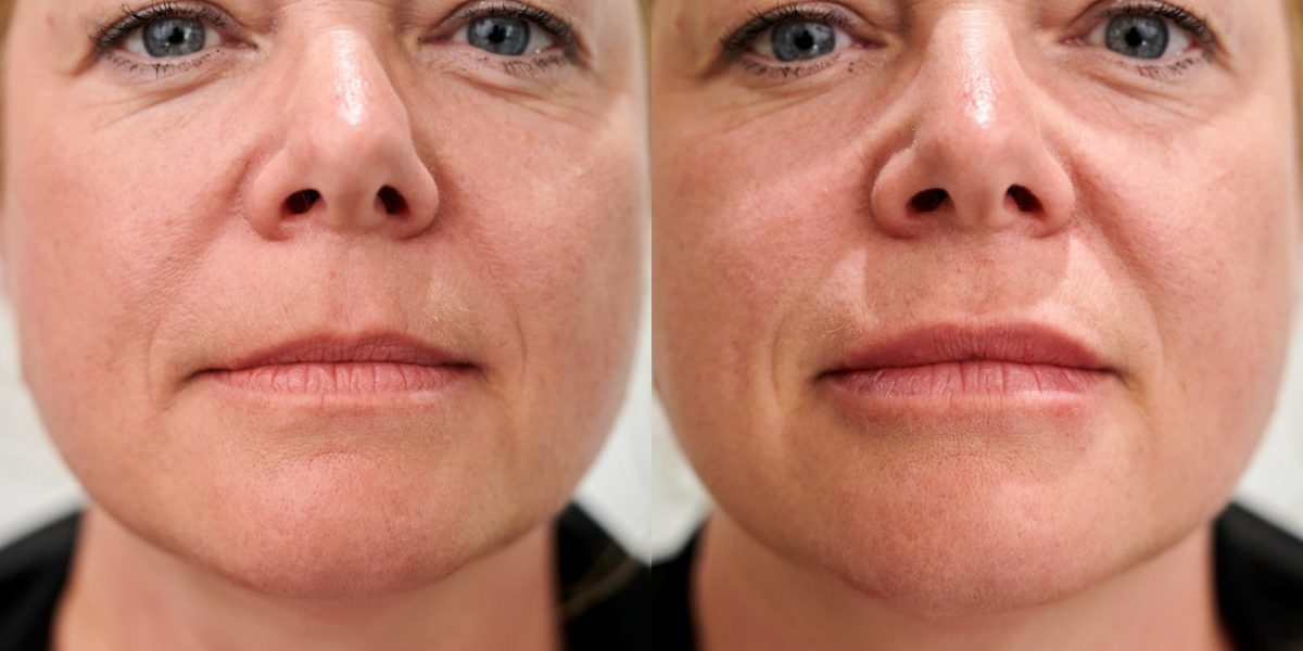 Lip Fillers Before & After | Lip Filler Treatment Results