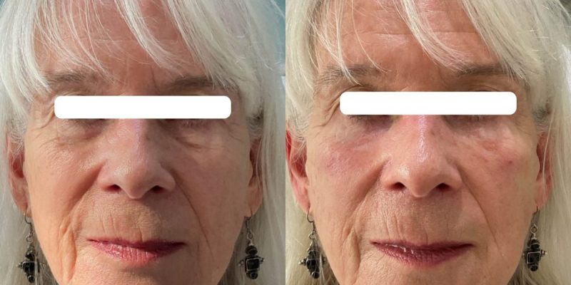 Tear Trough Fillers Before & After | Light Touch Clinic