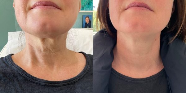 Profhilo Before & After | Light Touch Clinic