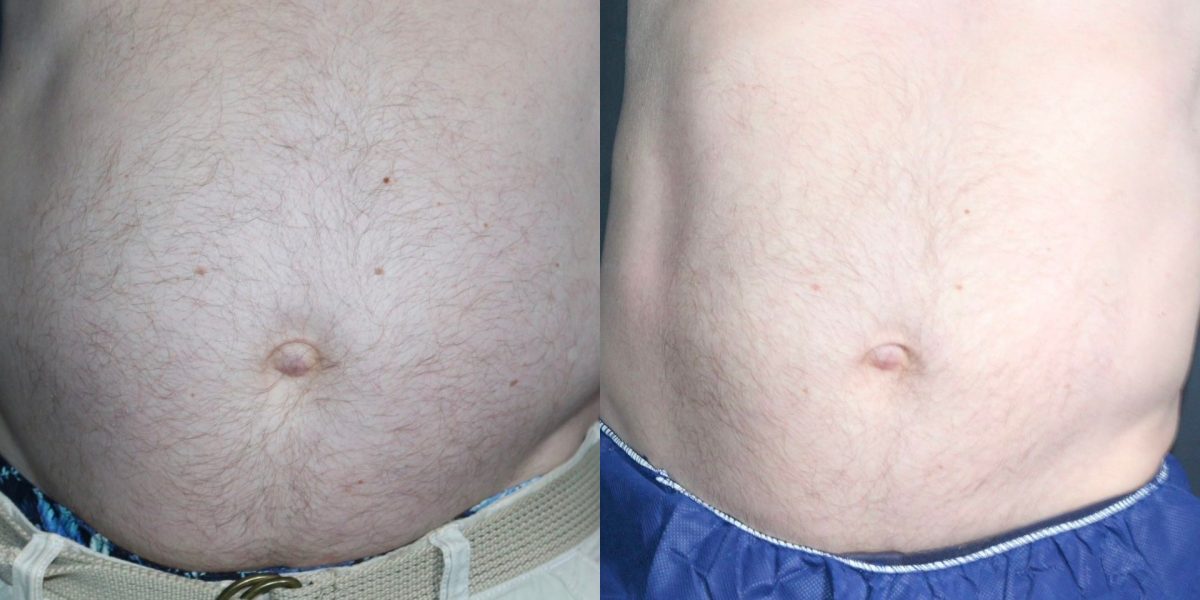 Emerald Fat Reduction Before & After | Fat Reduction Results